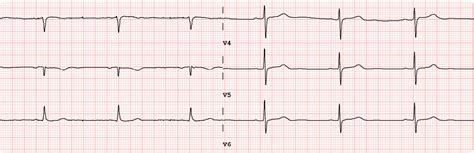 Bradycardia With A Pulse Algorithm