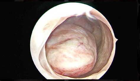 The Act Of Hysteroscopy In Detecting Endometrial Cancer National