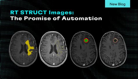 Age Dependent Cutoffs For Pathological Brain Volume Loss Cortechs Ai