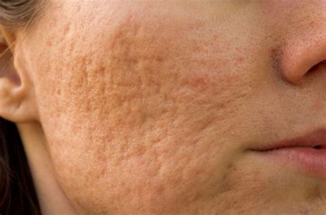Acne Scars Forehead