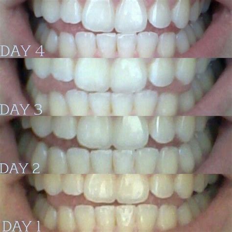 Oil Pulling White Teeth