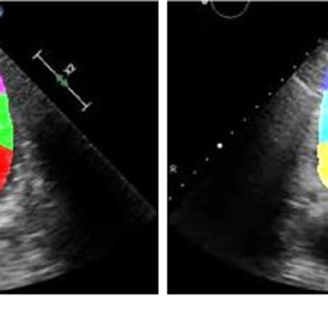 State Diagram Of The ROI Before And After Myocardial Contraction A