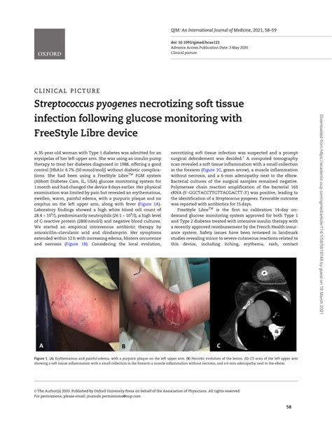 Pdf Streptococcus Pyogenes Necrotizing Soft Tissue Infection