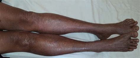 Resolved Cutaneous Skin Lesions Over Bilateral Legs Download