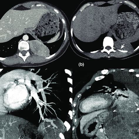 A Axial Ct Image After Iv Contrast Material Administration Showed An