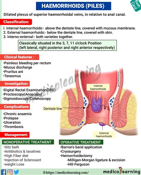 Hemorrhoids Medicolearning
