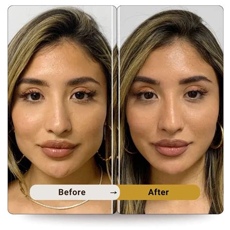 Masseter Botox Dubai Elite Body Home Aesthetic Clinic