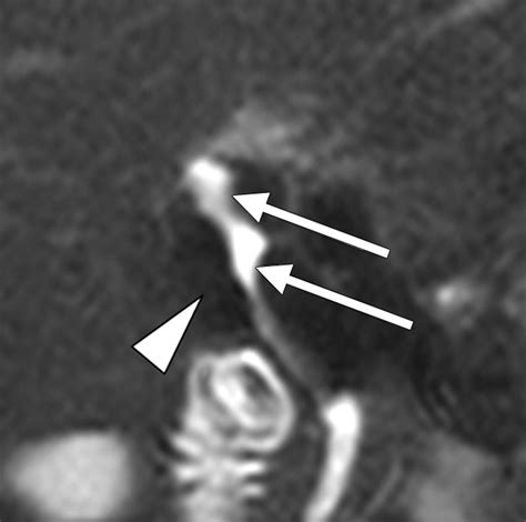 Biliary Abnormalities Associated With Portal Biliopathy Evaluation On