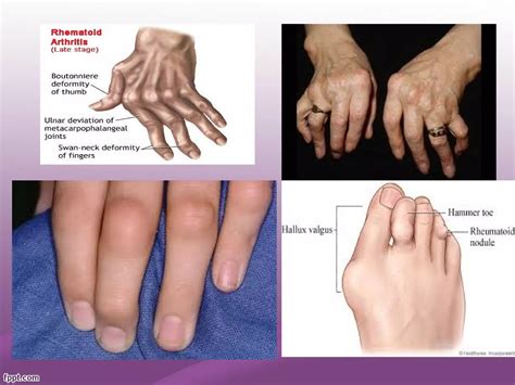 Osteoarthritis Ppt Free Download
