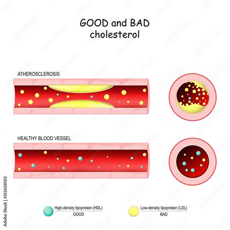 Plakat Good HDL And Bad LDL Cholesterol Healthy Blood Vessel And Atherosclerosis
