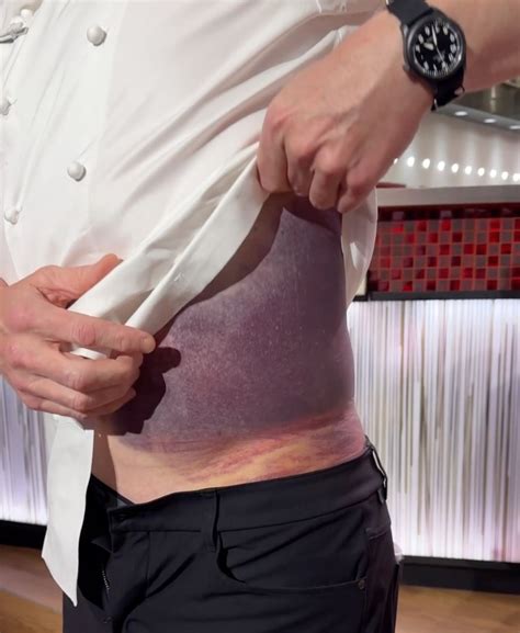 Gordon Ramsay 57 Shows Off Gruesome Injuries After Scary Bike Accident