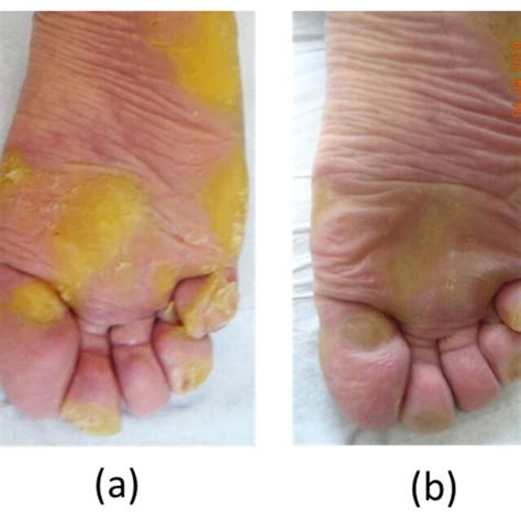 Evolution Of Plantar Keratoderma In Patient 1 A Skin Lesions In Download Scientific Diagram