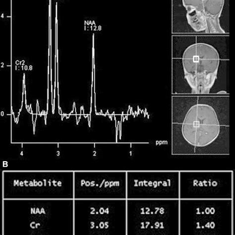Eeg Of A Patient With Sspe Note Longitudinal Bipolar Montage Showing