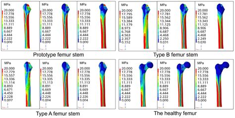 Multi Scale Topology Optimization Of Femoral Stem Structure Subject To Stress Shielding Reduce