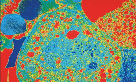 Research Brief The Lancet Infectious Diseases