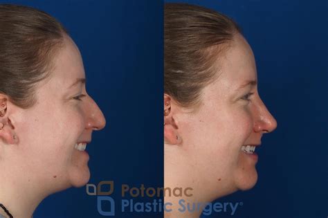 Bump Reduction In Rhinoplasty Potomac Plastic Surgery