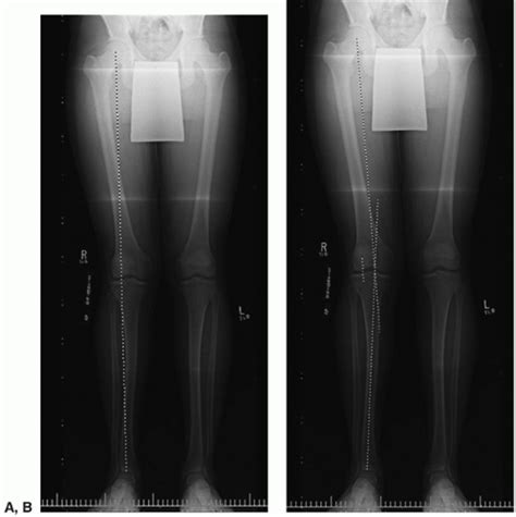 Distal Femoral Osteotomy Musculoskeletal Key