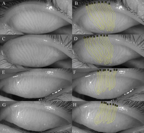 Figure 2 From Meibomian Gland Morphology Among Patien