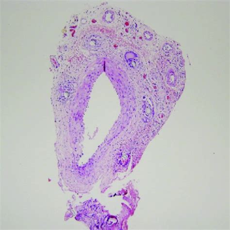 Endothelialization Is Seen Without Any Inflammation And Foreign Body