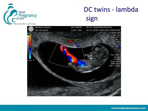 Ppt Multiple Pregnancy Powerpoint Presentation Free Download Id623316