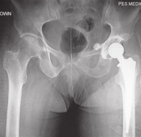 x ray of lumbosacral spine showing intervertebral disk calcification