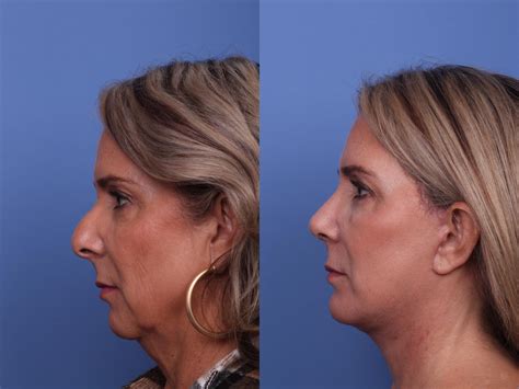 Facelift Before And After Pictures Case 457 Scottsdale And Phoenix Az Hobgood Facial Plastic