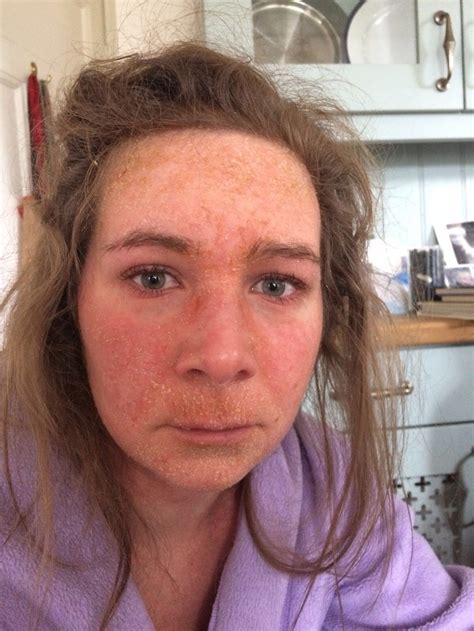 Horrific Reaction To Eczema Cream Leaves Womans Skin Peeling Off And