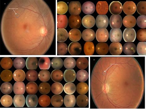 Revolutionizing Vision Diabetic Retinopathy Ai Innovations