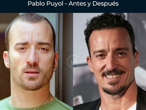 Injerto capilar antes y después de famosos descubre su transformación Cirugía Capilar de