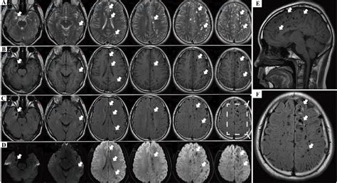 Giant Tumefactive Perivascular Spaces Semantic Scholar