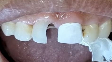 Composite Dental Filling 11 Youtube