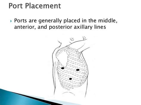 Video Assisted Thoracic Surgery Vats