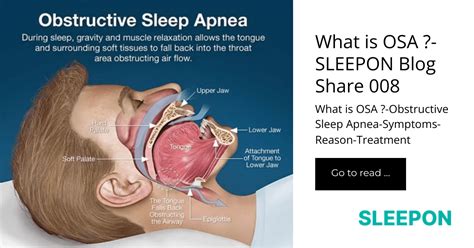 What Is Osa Obstructive Sleep Apnea Symptoms Reason Treatment Sleepon Sleepon