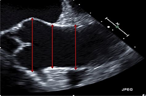 Aortic Root Measurement