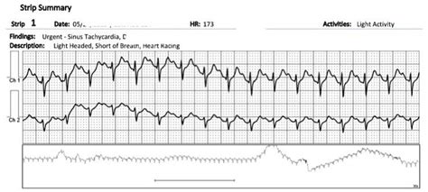 Possible Interpretation R Readmyecg