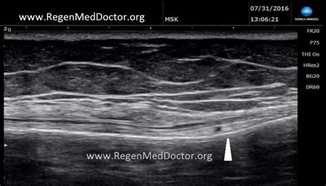 Genicular Nerve Observed Under Ultrasound