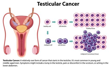 Free Vector Male Anatomy Diagram Of Testicular Cancer