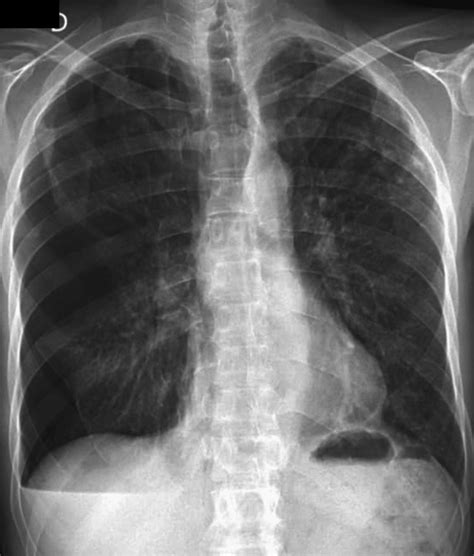 Managing Pneumothorax In Neurofibromatosis Type 1 A Report Of A Rare