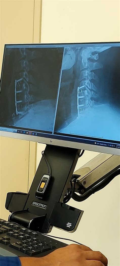 And Another One R Spinalfusion