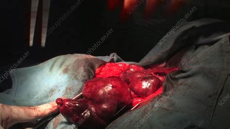 Goitre Removal 28 Of 50 Stock Video Clip K0110702 Science Photo