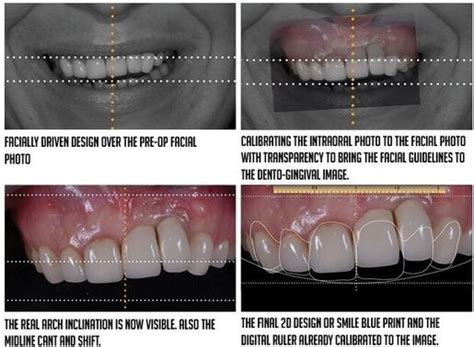 Discover The Evolution Of Smile Design Techniques A Comprehensive