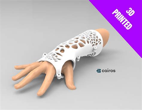 Arm Splint 3d Print 3d Model 3d Printable Cgtrader
