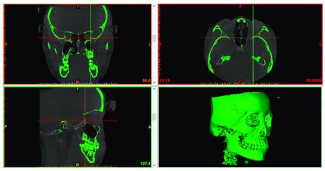 An Initial Segmentation Mask From The Cbct Data Download Scientific