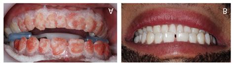 Dental Bleaching A 38 Hydrogen Peroxide Gel Applied On The