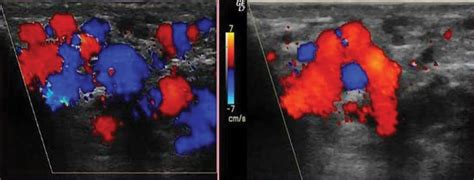 Selecting Patients For Embolization Of Varicoceles Based On Ultrasonography Pmc