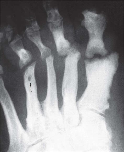 18 Bone Infection Musculoskeletal Key