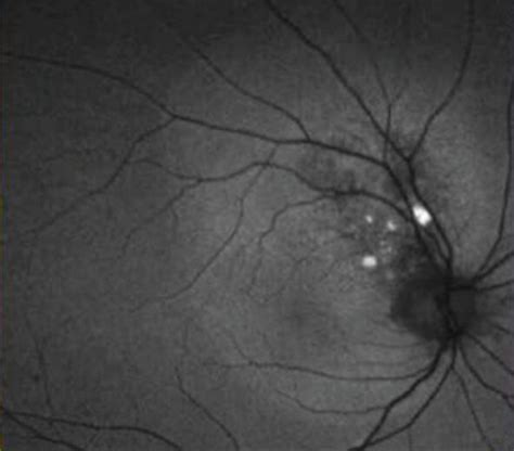 Right Eye At Presentation A Fundus Photograph Showing Choroidal Mass