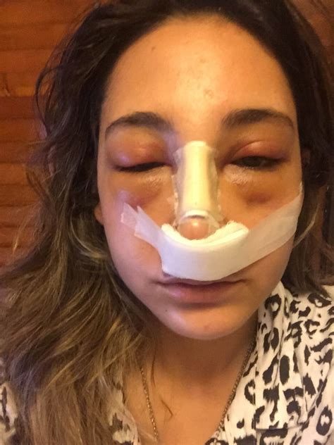Post operatorio Rinoplastía día por día Rinoplastia Blog