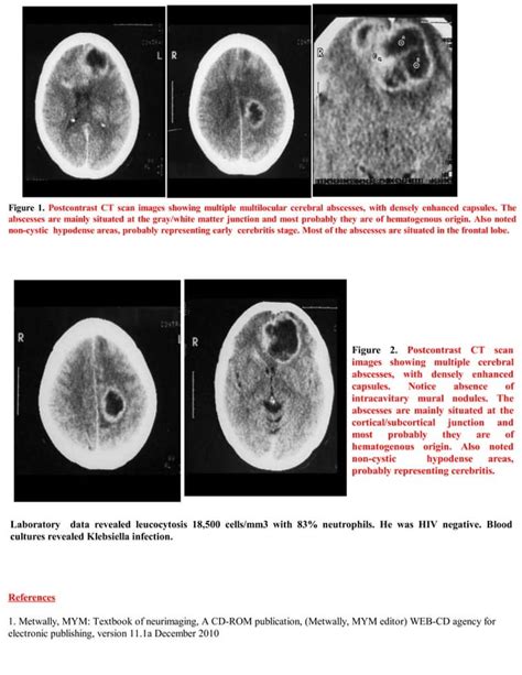 Short Casemultiple Pyogenic Brain Abscesses Pdf