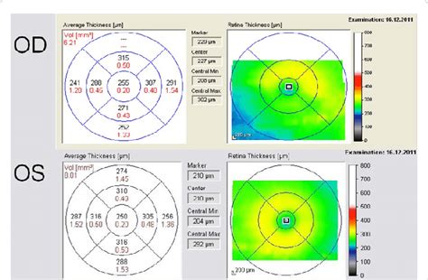 Spectral Domain Optical Coherence Tomography Of Both Eyes Macular